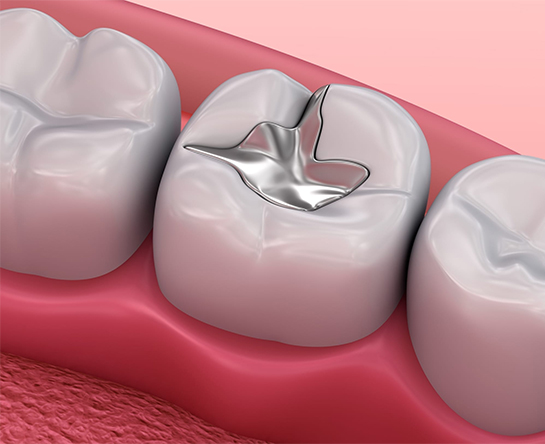 Restorative Dentistry In Mckinney Pixel Dental